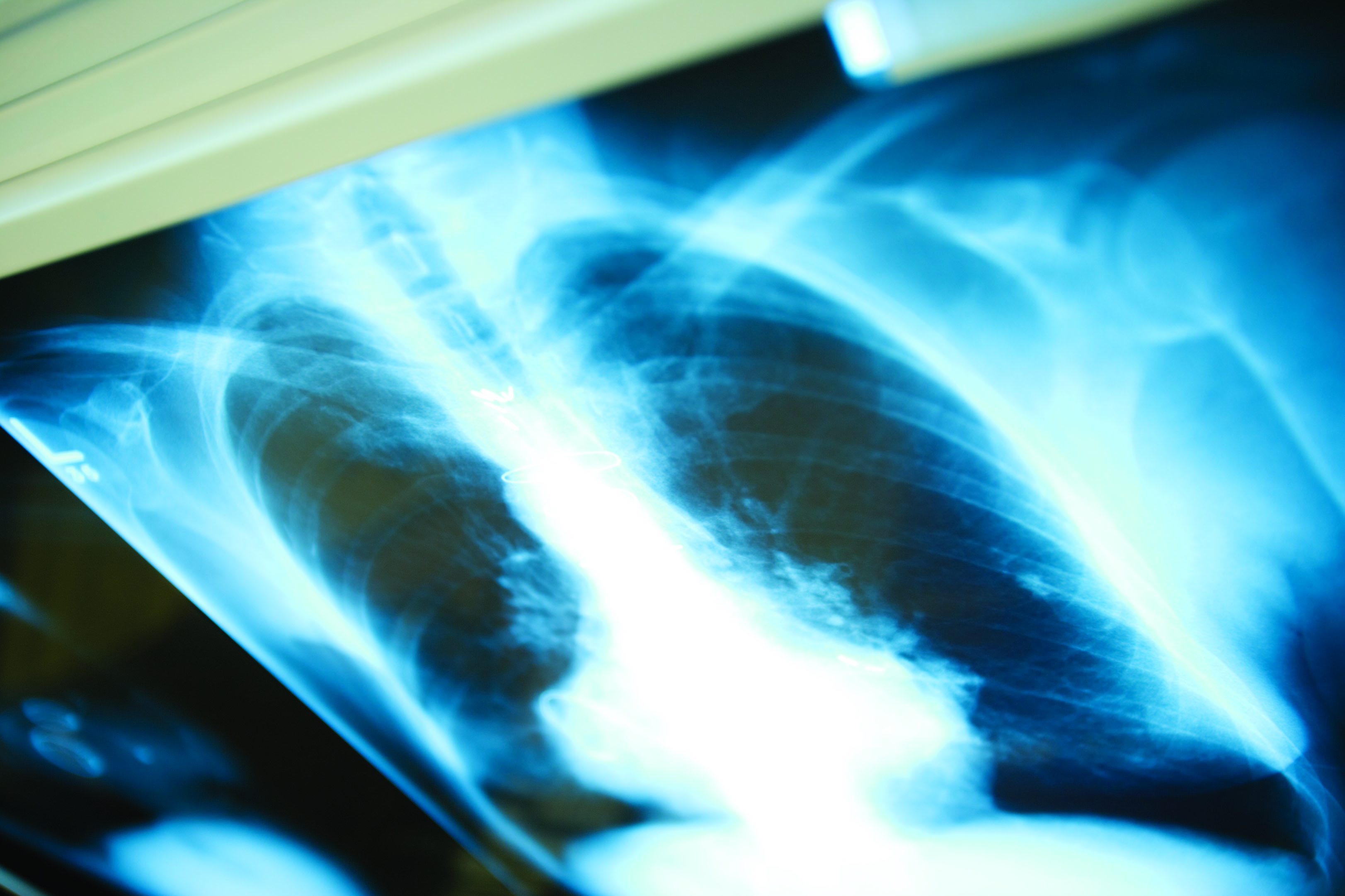 Detecting Lung Cancer Early with EBUS | Lung Center of Nevada Detecting Lung Cancer Early with EBUS | Lung Center of Nevada